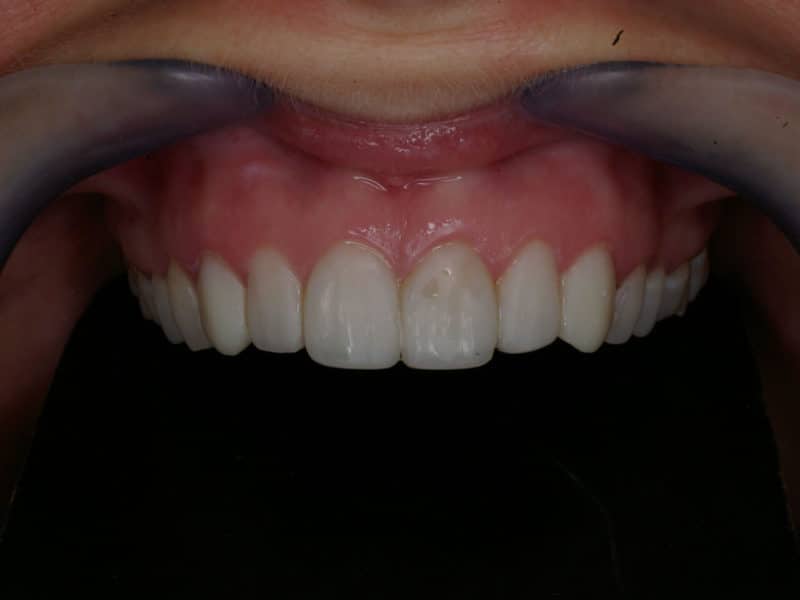 Aesthetic Dental Filling - City Clinic - Douglas